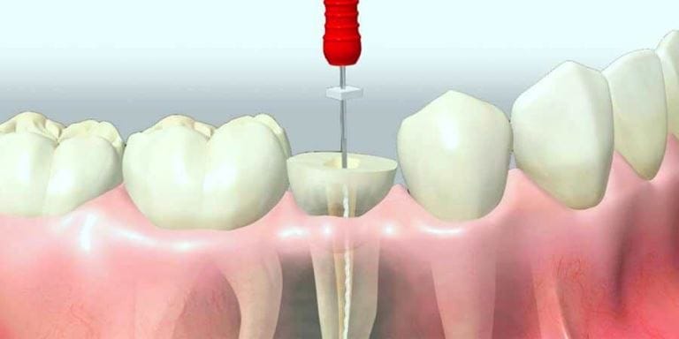 Ce este rezectia apicala si cand este indicata - Miko Dental 1