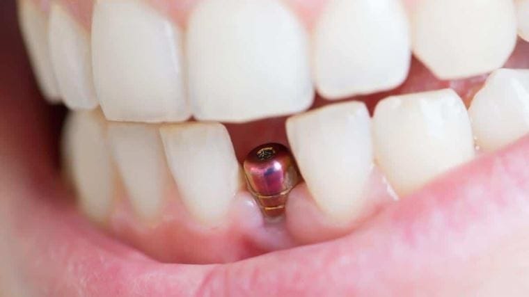 Pivot dentar versus implant dentar - Miko Dental