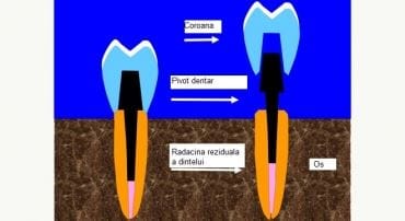 Pivotul dentar: rol, tipuri, caracteristici, pret | Miko Dental