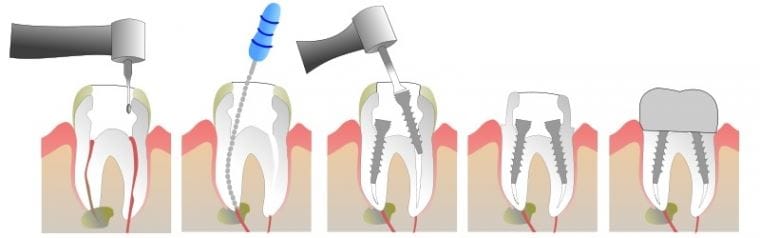 Pivotul dentar: rol, tipuri, caracteristici, pret | Miko Dental