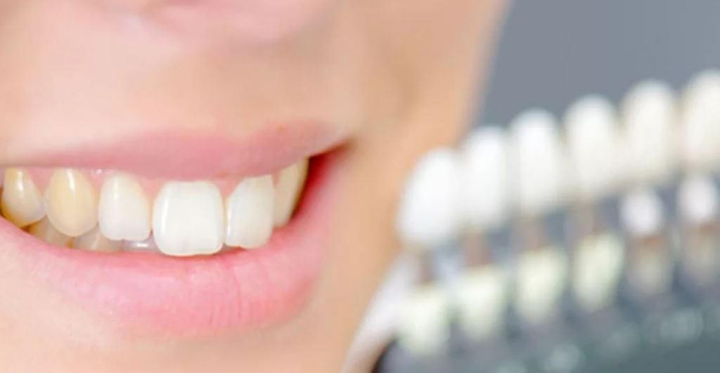Discromia dentara: cauzele patarii dintilor - Miko Dental 1